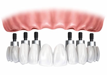 Dental Implants in Victoria, BC: We Can Transform Your Smile!